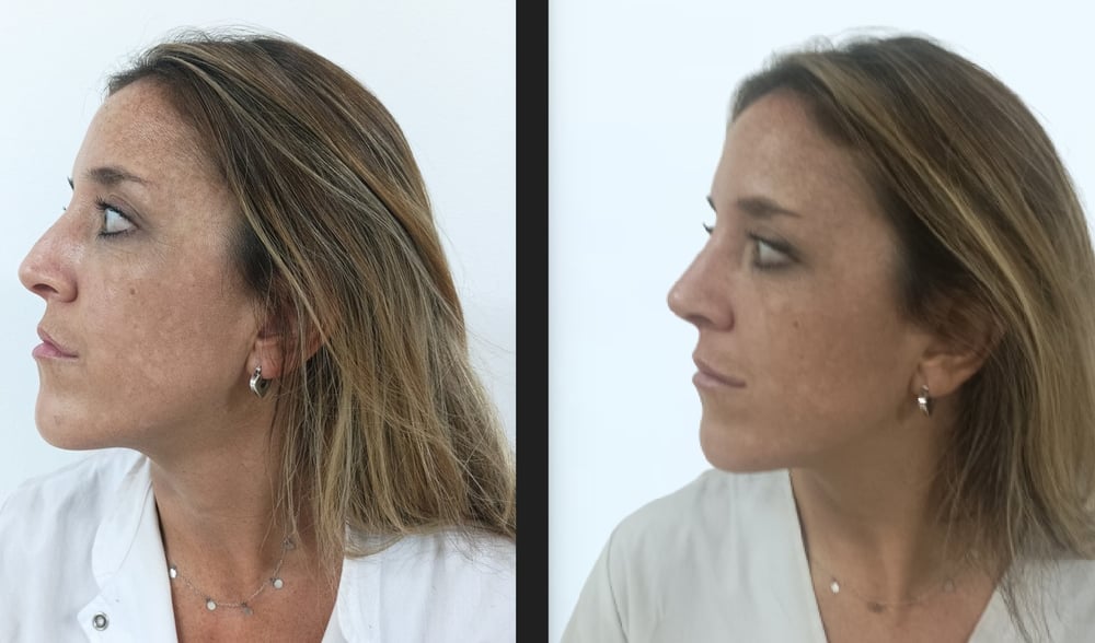 Rinomodelación con Ácido Hialurónico | Dermatología y Estética